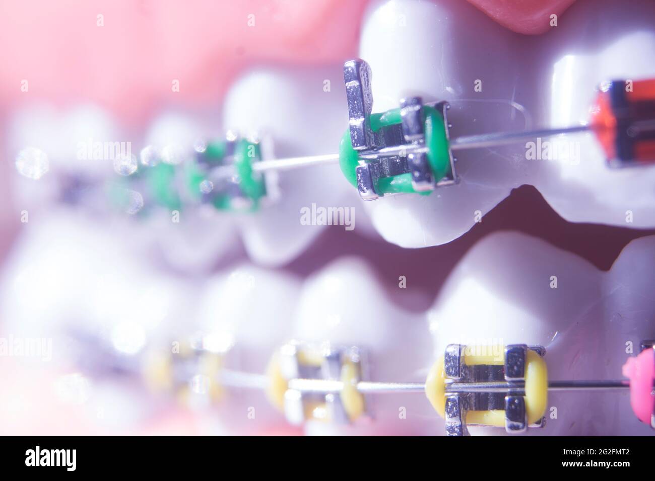 Modern metal brackets aligner straighterners used to correct alignment ...