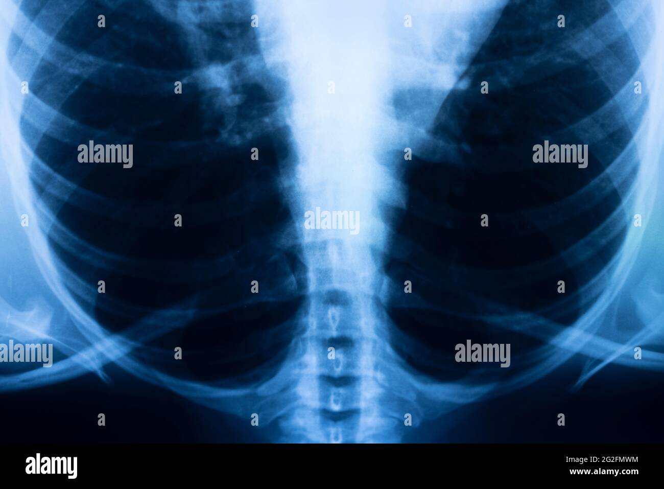 Lungs ribs x-ray scan test result Stock Photo - Alamy