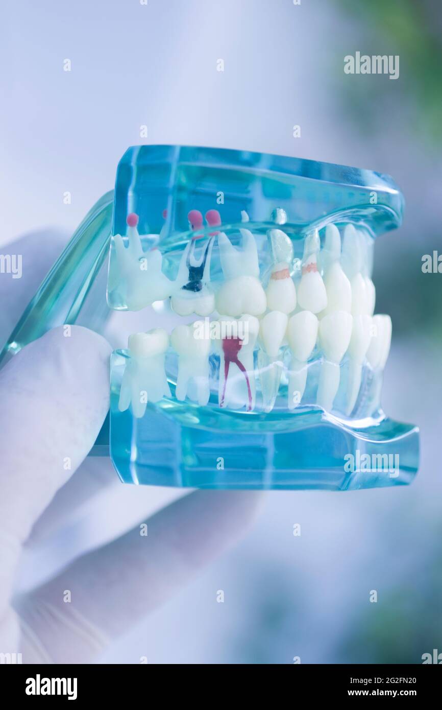 Teeth decay dentistry model showing caries in tooth Stock Photo - Alamy