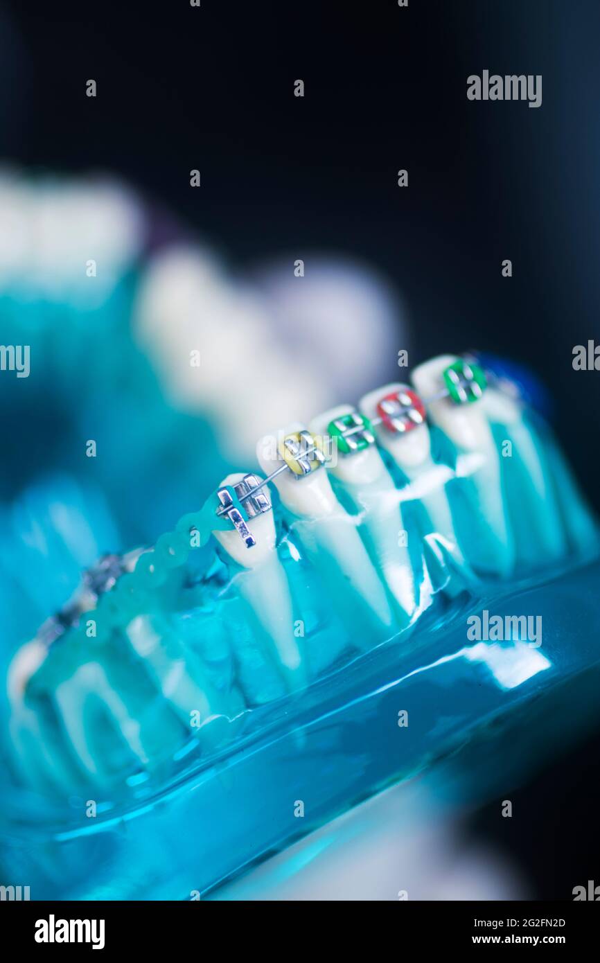 Dental teeth aligner bracket teaching student model showing gums and ...