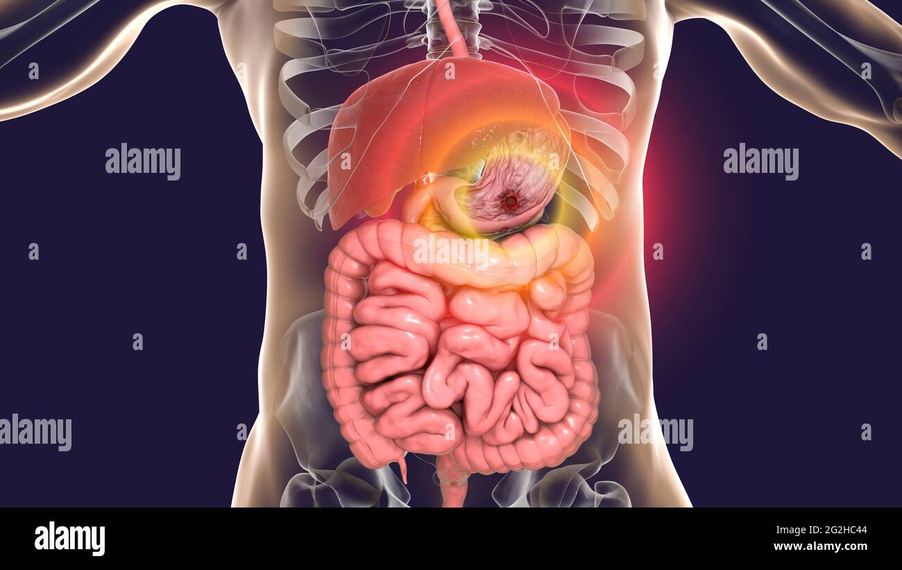 Gastric perforation hi-res stock photography and images - Alamy