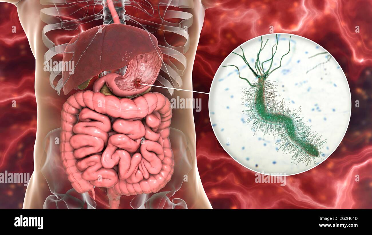 Gastric ulcer and Helicobacter pylori bacteria, illustration Stock ...