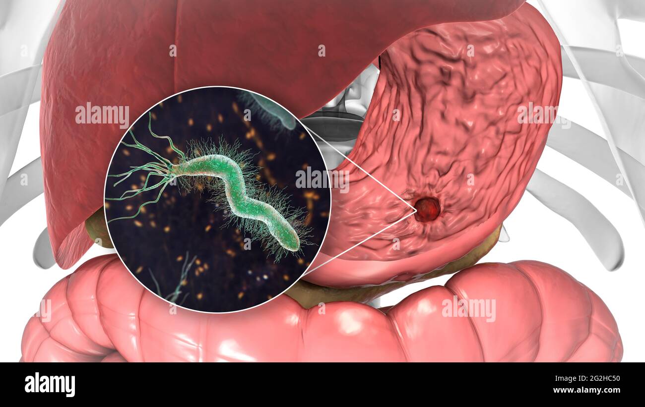Gastric ulcer and Helicobacter pylori bacteria, illustration Stock ...