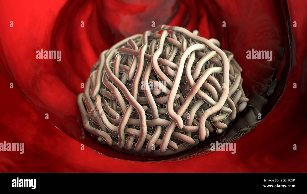 Round worms in human intestine, illustration Stock Photo - Alamy