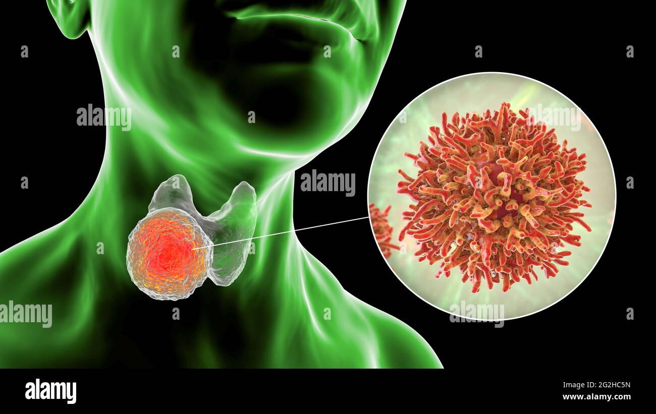 Thyroid gland cancer, illustration Stock Photo - Alamy