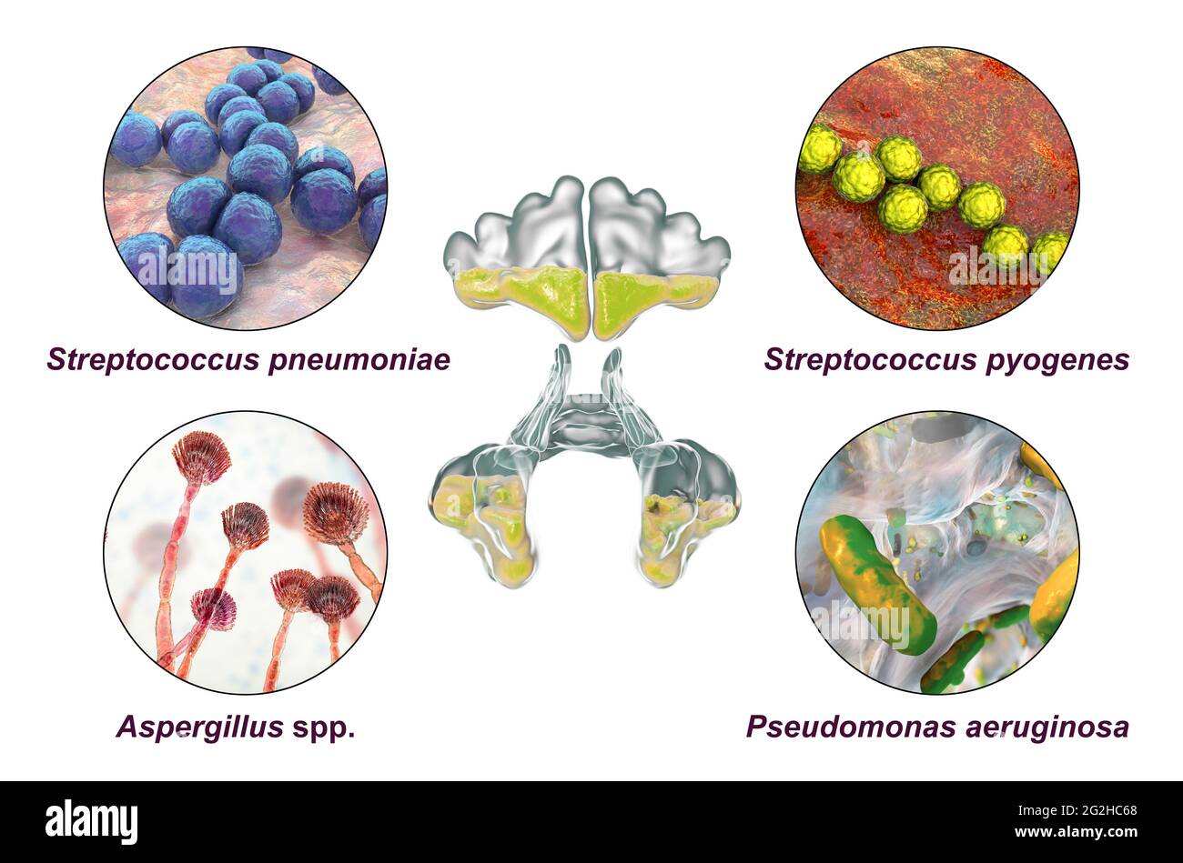 Fungal sinusitis hi-res stock photography and images - Alamy