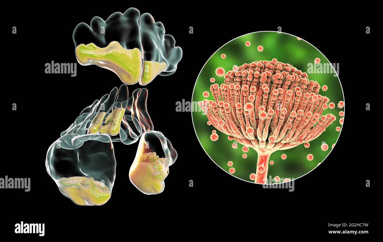 Fungal sinusitis hi-res stock photography and images - Alamy