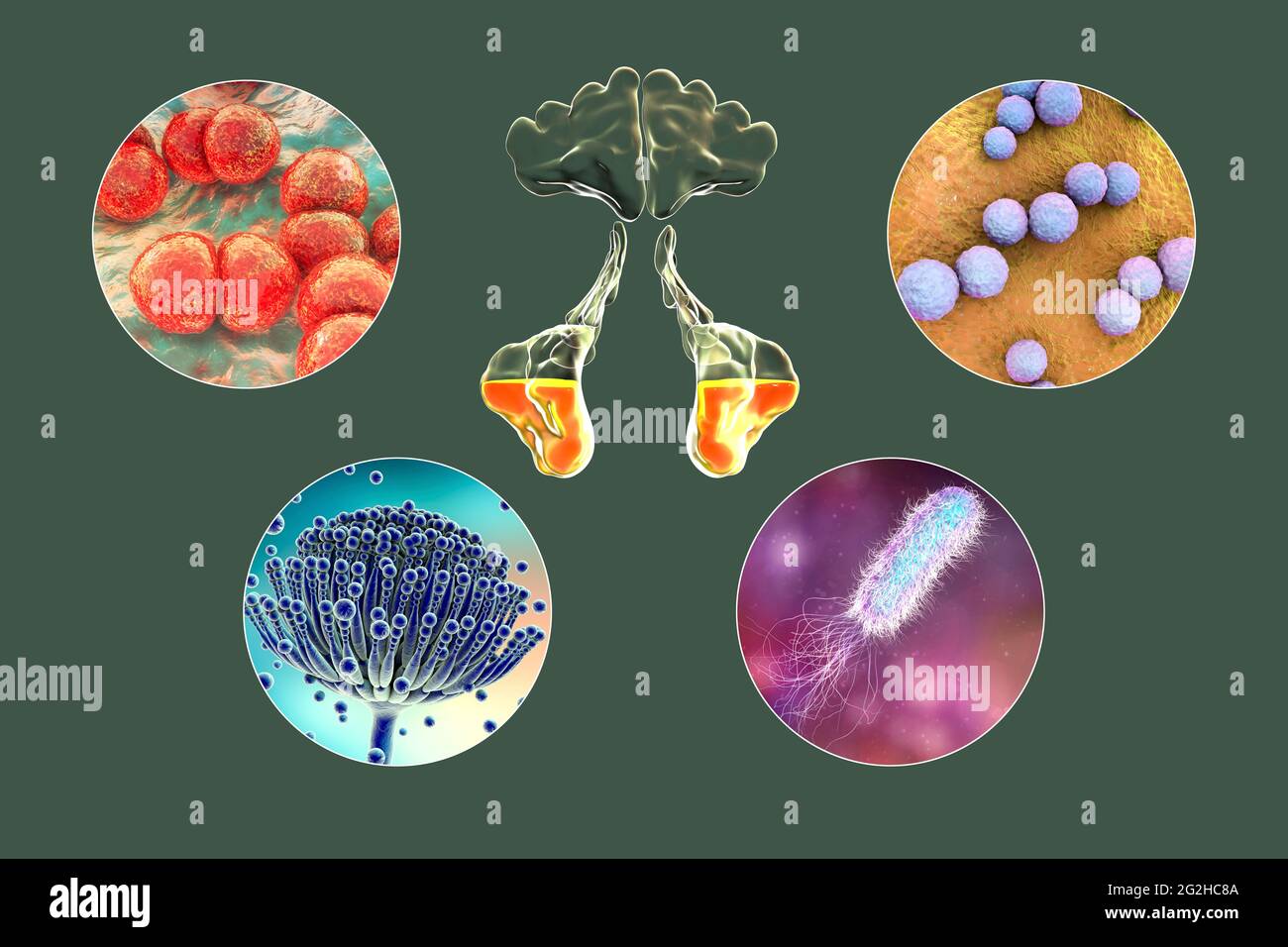 Fungal sinusitis hi-res stock photography and images - Alamy