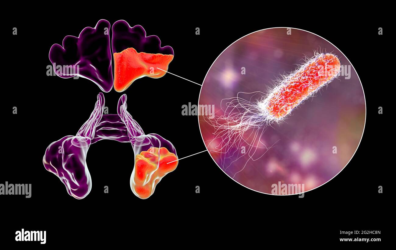 Chronic sinusitis hi-res stock photography and images - Alamy