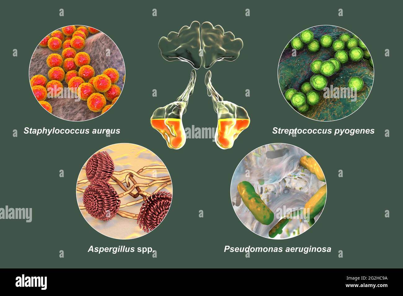 Fungal sinusitis hi-res stock photography and images - Alamy