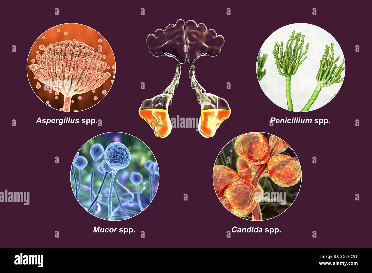 Fungal sinusitis hi-res stock photography and images - Alamy