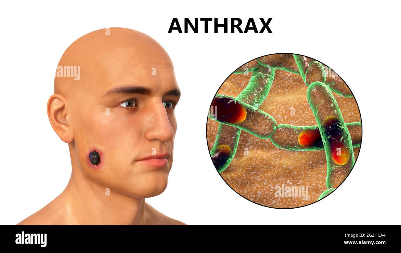Cutaneous anthrax, illustration Stock Photo - Alamy