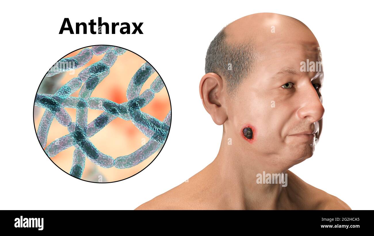 Cutaneous anthrax, illustration Stock Photo - Alamy