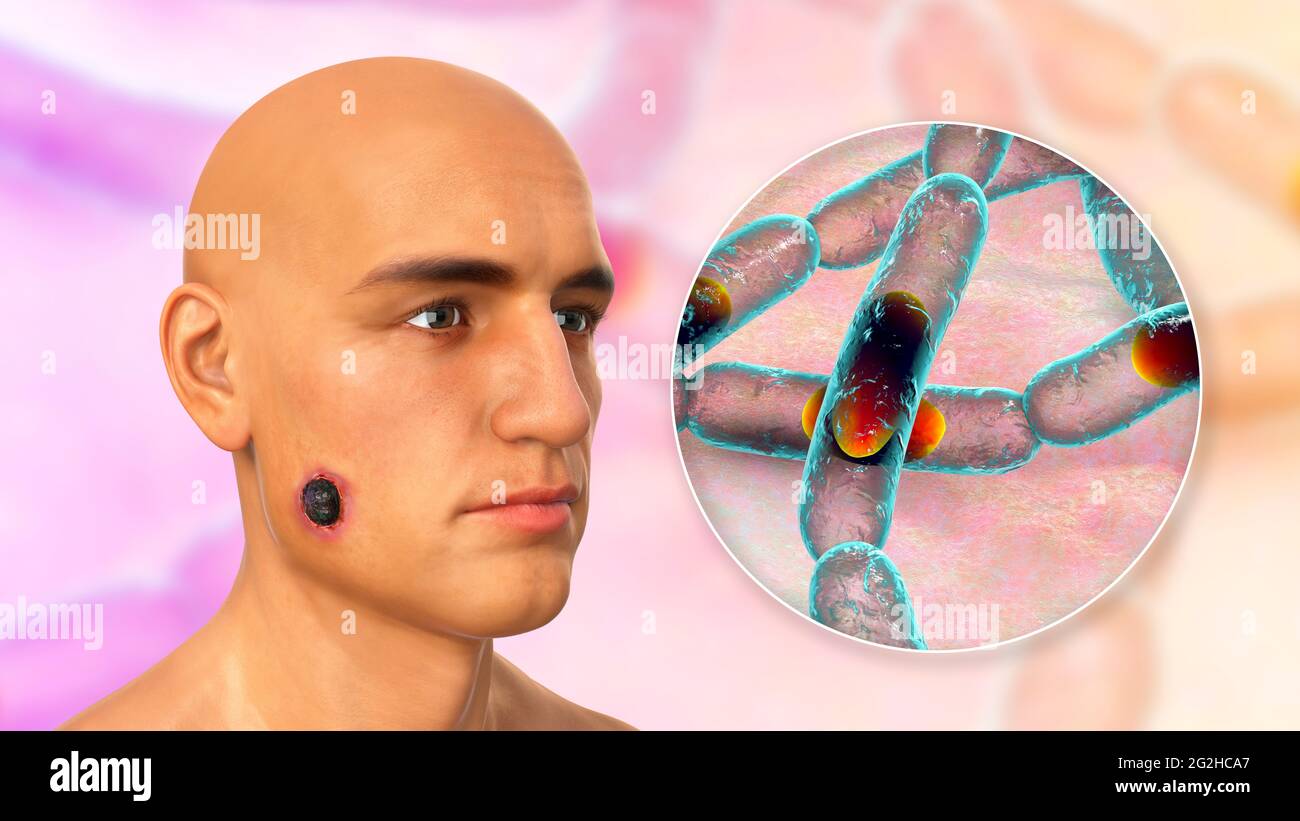 Cutaneous anthrax, illustration Stock Photo - Alamy