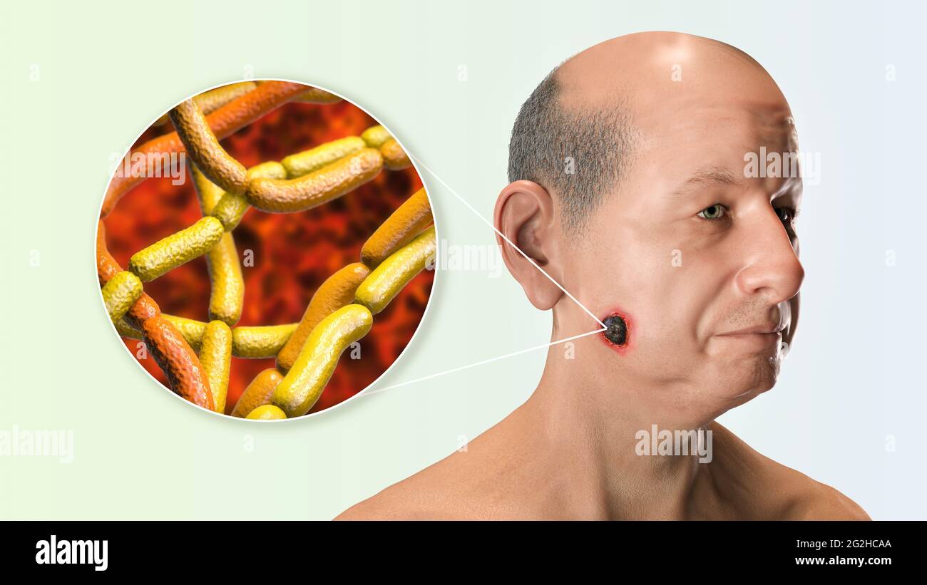 Cutaneous anthrax, illustration Stock Photo - Alamy
