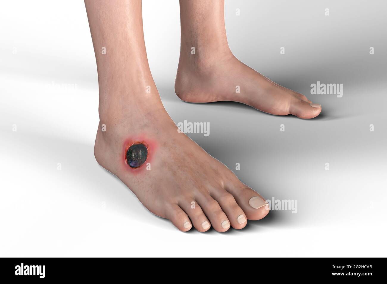 Cutaneous anthrax, illustration Stock Photo - Alamy