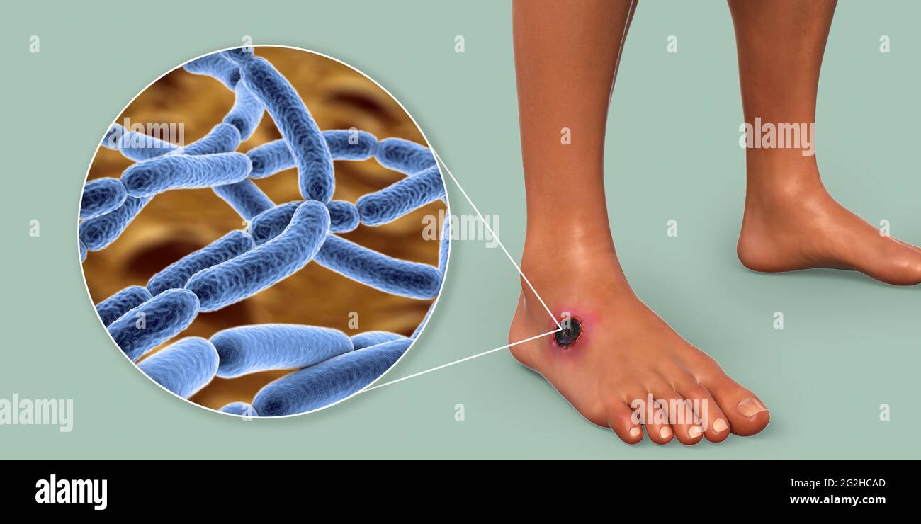 Cutaneous anthrax, illustration Stock Photo - Alamy