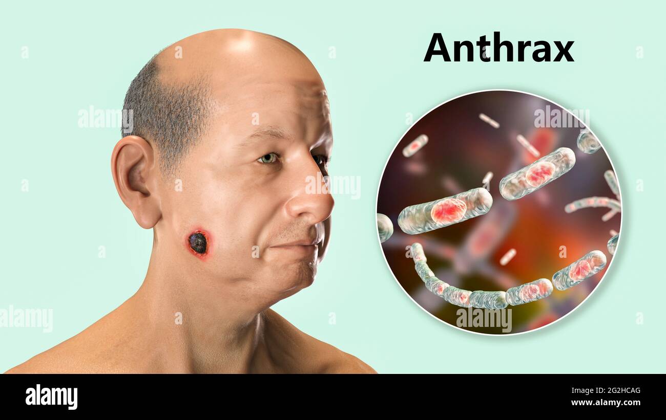 Cutaneous anthrax, illustration Stock Photo - Alamy
