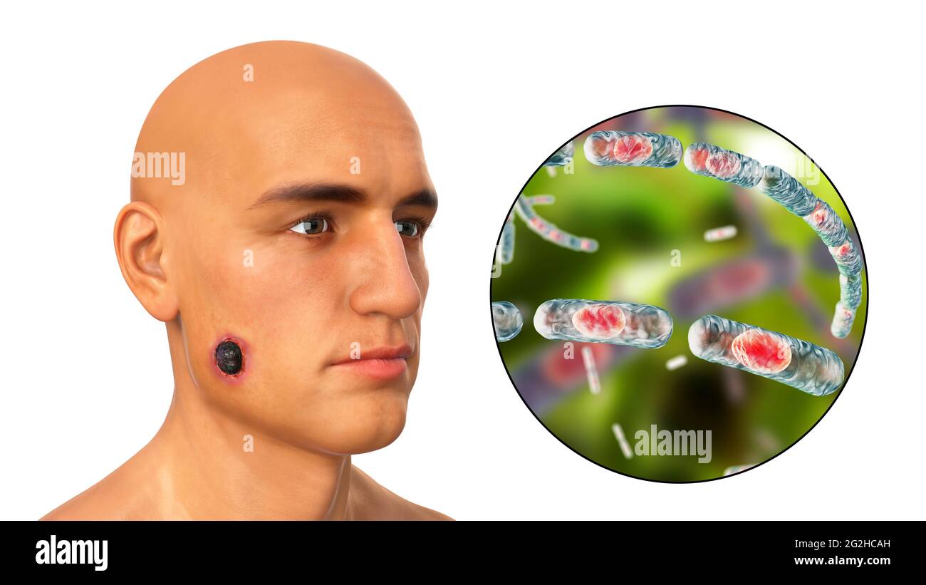 Cutaneous anthrax, illustration Stock Photo - Alamy