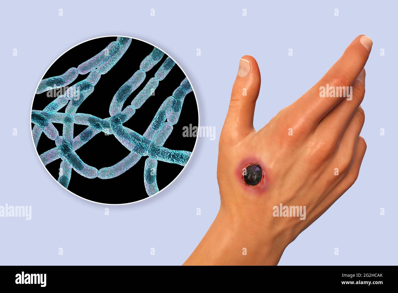 Cutaneous anthrax, illustration Stock Photo - Alamy