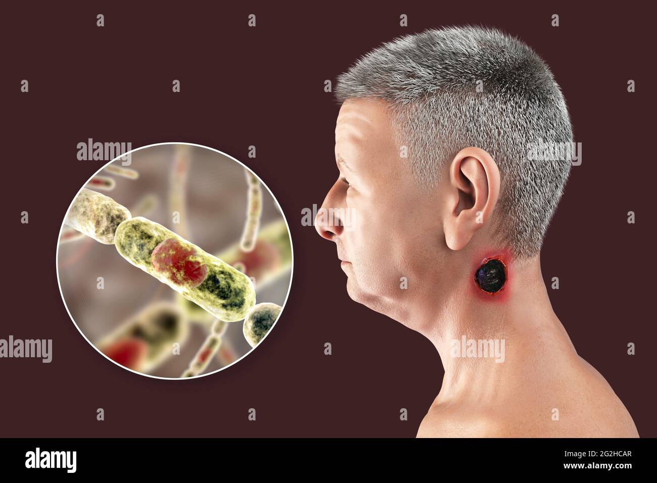Cutaneous anthrax, illustration Stock Photo - Alamy