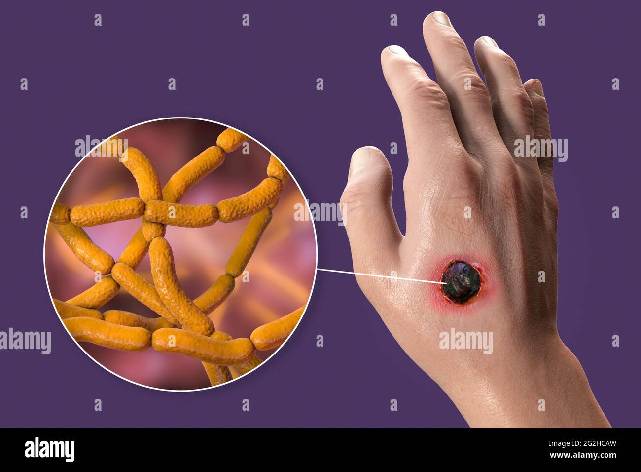 Cutaneous anthrax, illustration Stock Photo - Alamy