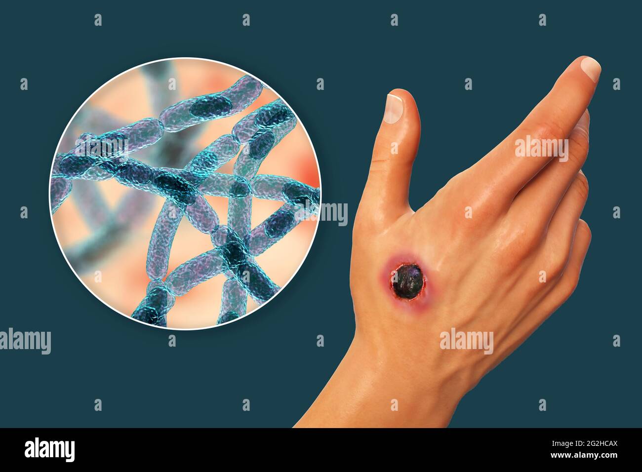 Cutaneous anthrax, illustration Stock Photo - Alamy