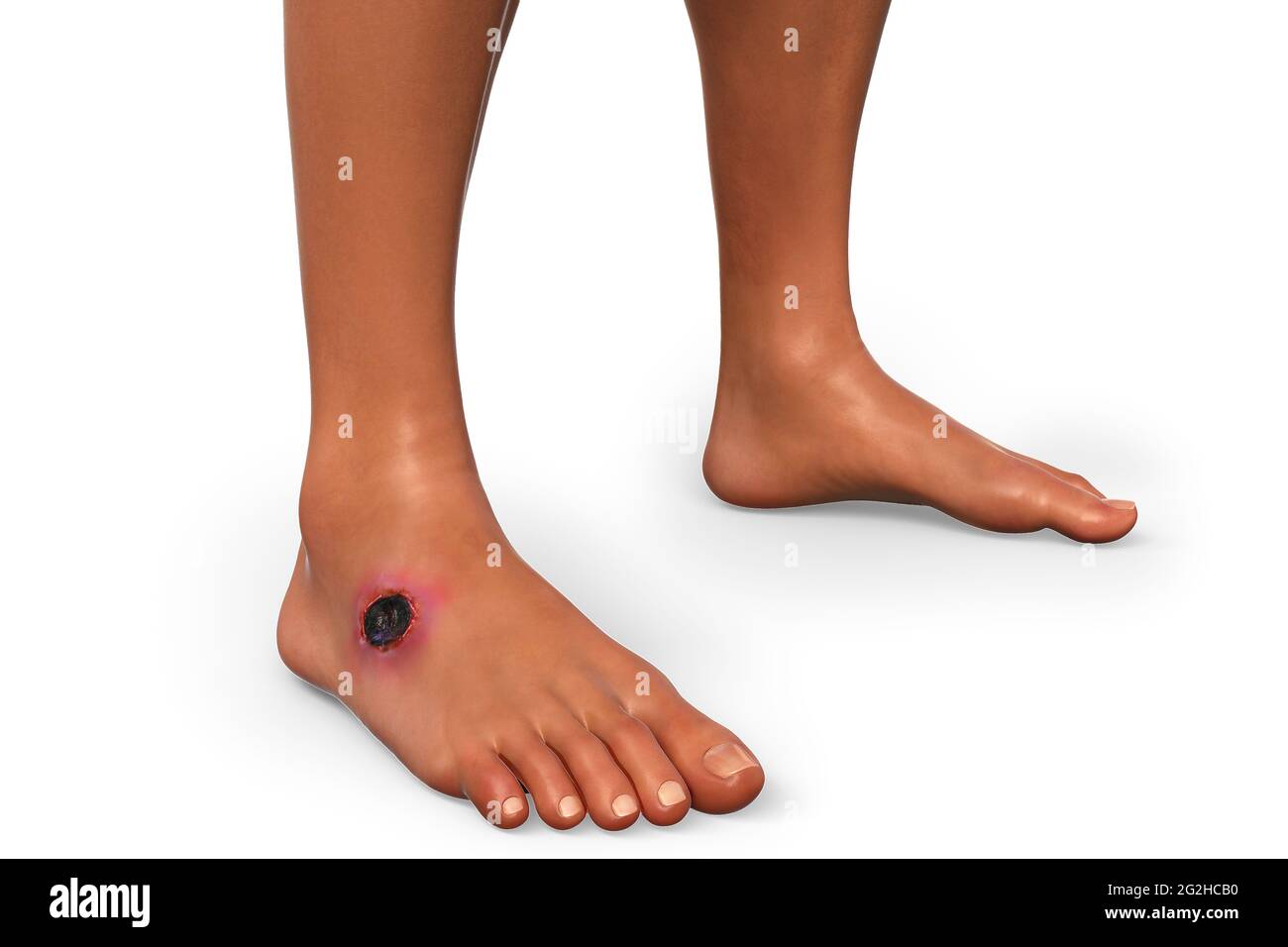 Cutaneous anthrax, illustration Stock Photo - Alamy