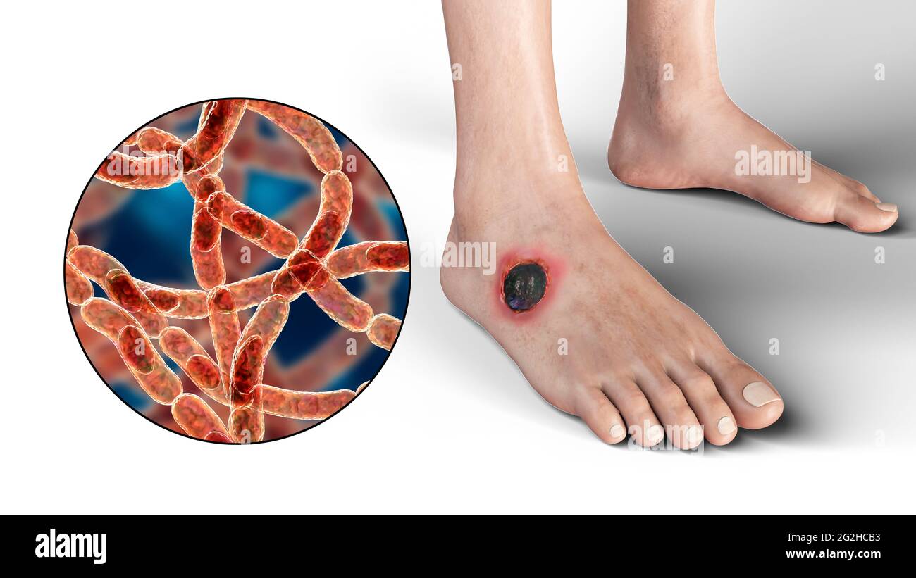 Cutaneous anthrax hi-res stock photography and images - Alamy