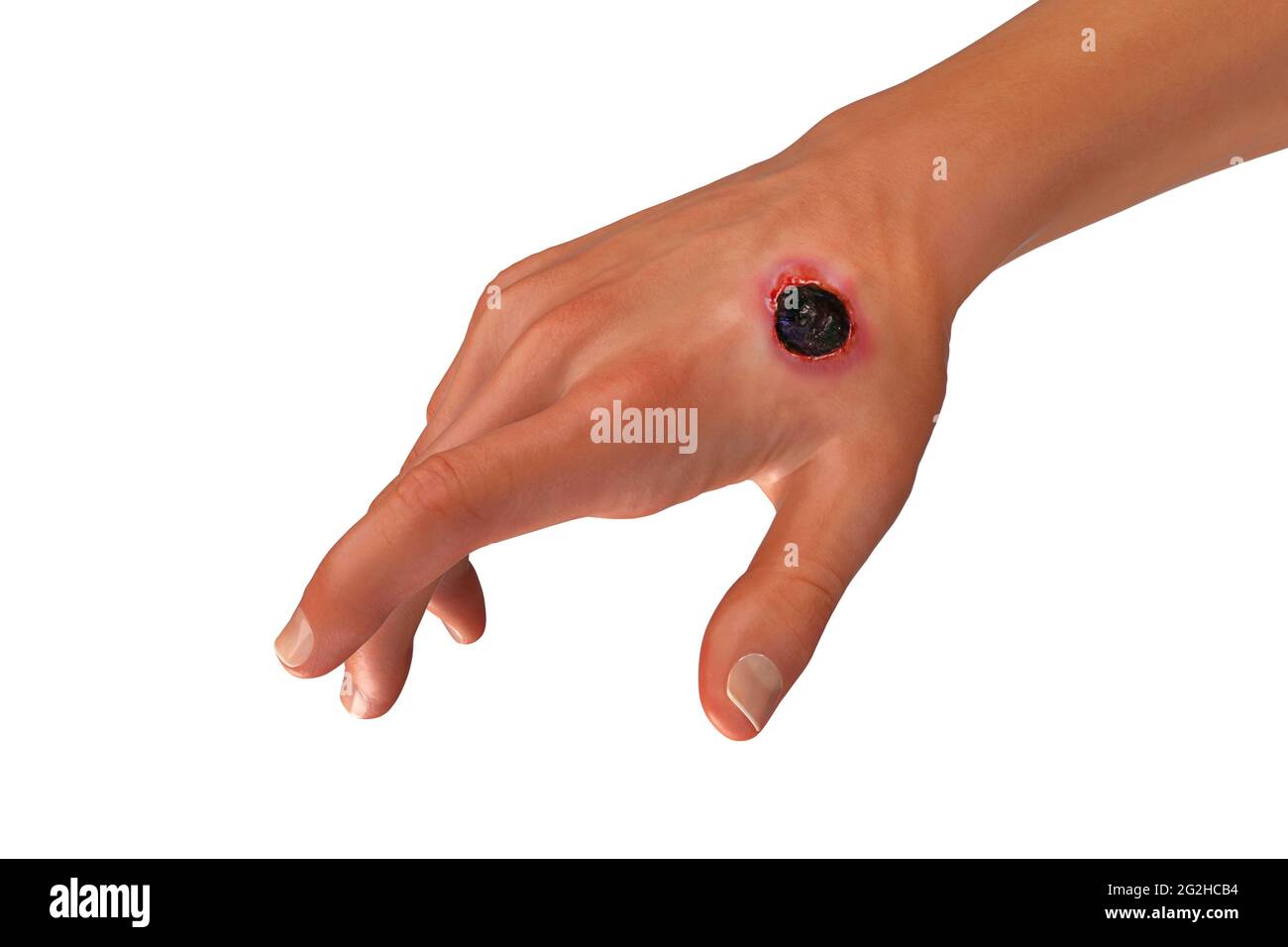 Cutaneous anthrax, illustration Stock Photo - Alamy