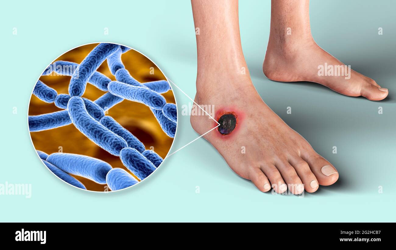 Cutaneous anthrax, illustration Stock Photo - Alamy