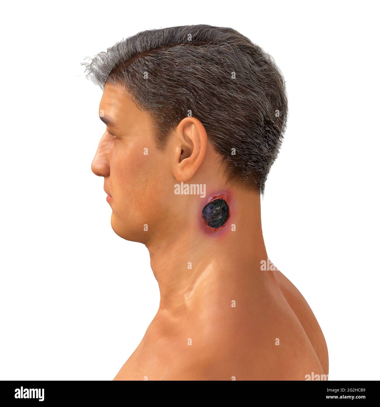 Cutaneous anthrax, illustration Stock Photo - Alamy