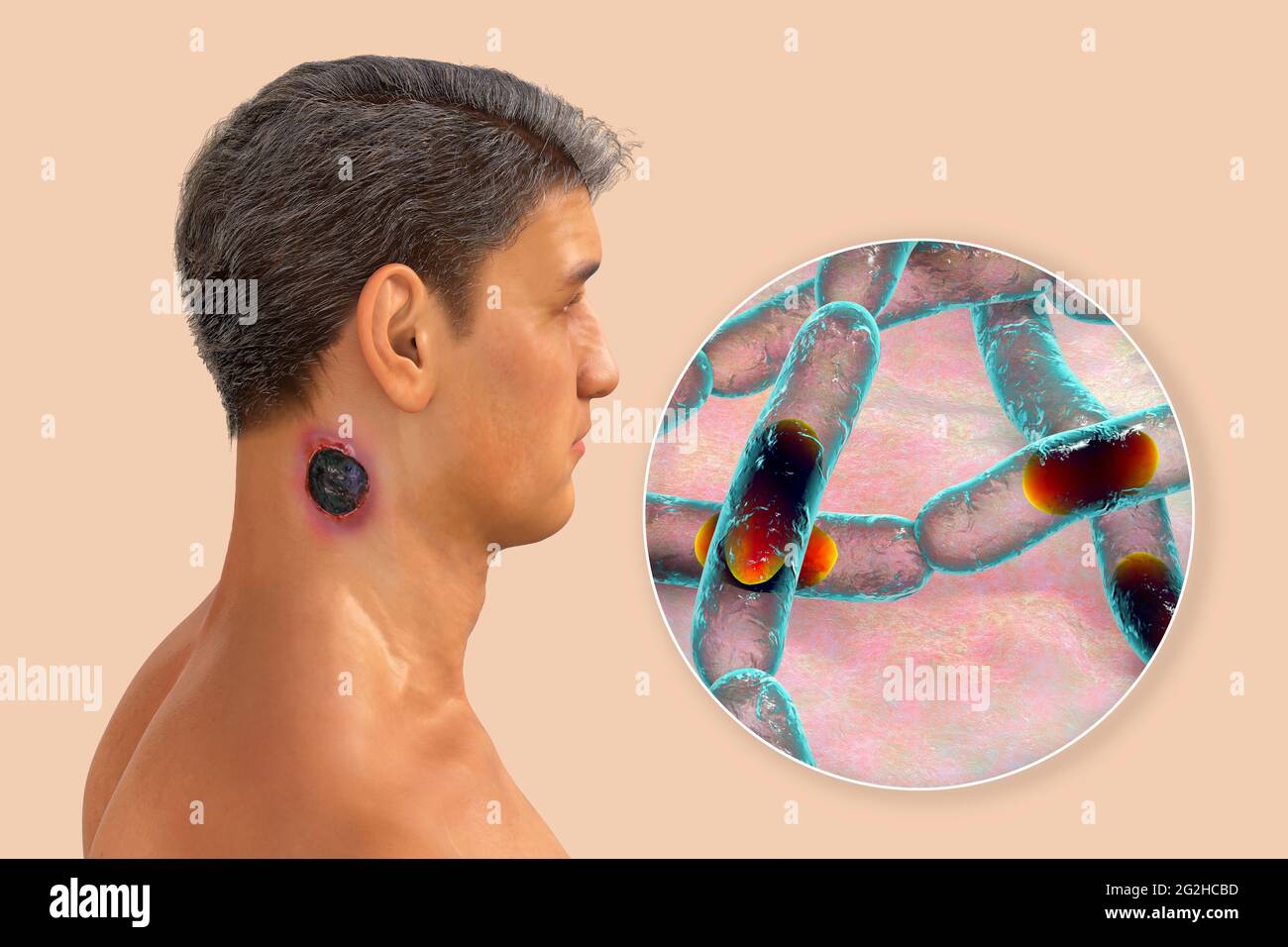 Cutaneous anthrax, illustration Stock Photo - Alamy