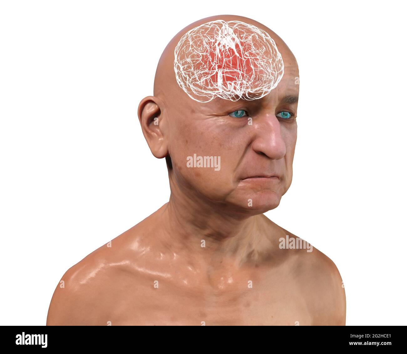 Alzheimer's disease brain hi-res stock photography and images - Alamy
