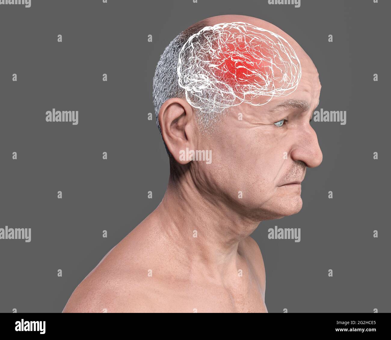 Elderly man's brain in dementia, conceptual illustration Stock Photo ...