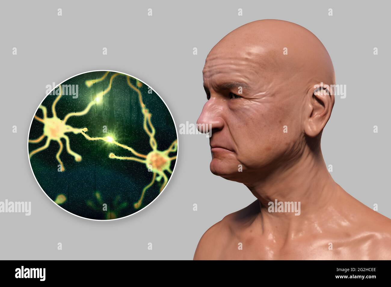 Dementia, conceptual illustration Stock Photo - Alamy Dementia, conceptual illustration Stock Photo - Alamy