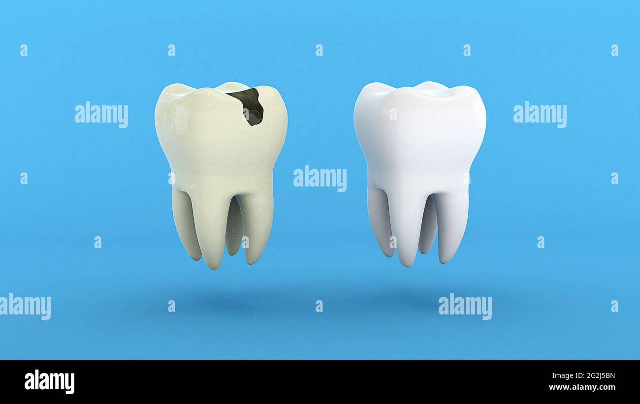 Bad tooth. A tooth with a crease and a hole and a healthy white tooth ...
