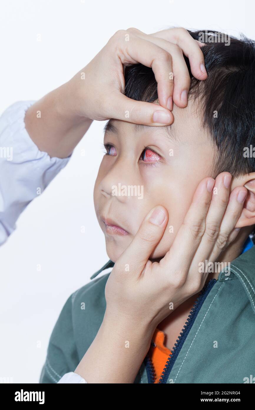 Pinkeye (conjunctivitis) infection on a little asian (thai) boy, doctor ...