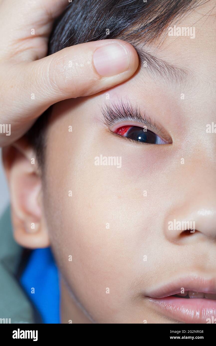Closeup of pinkeye (conjunctivitis) infection on a little asian (thai ...
