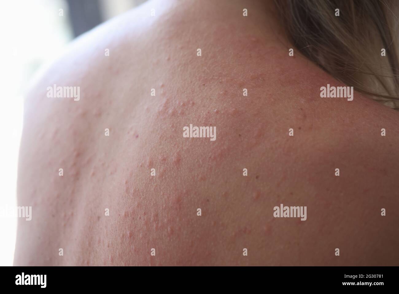 Woman injured back with rash and red sun spots Stock Photo - Alamy