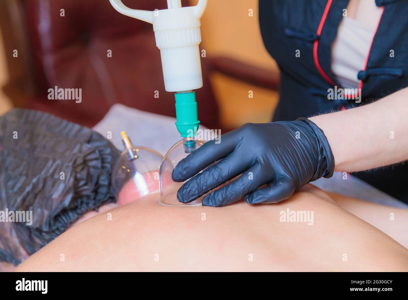 A hijama master performs a vacuum blood suction procedure for a young ...