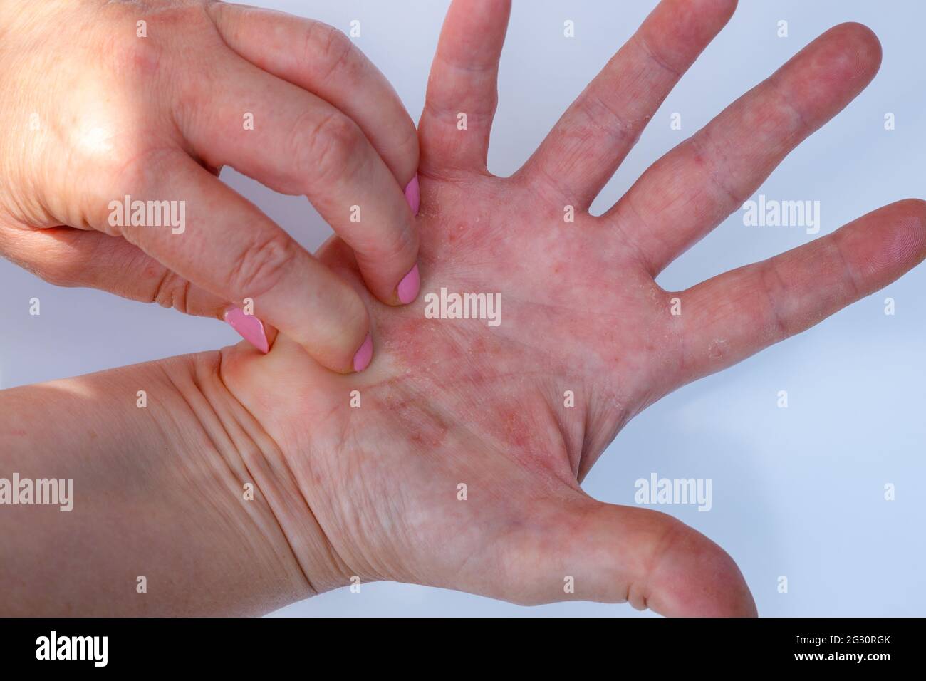 Woman Scratching Itchy Hands, Atopic Dermatitis, Red Hand ...