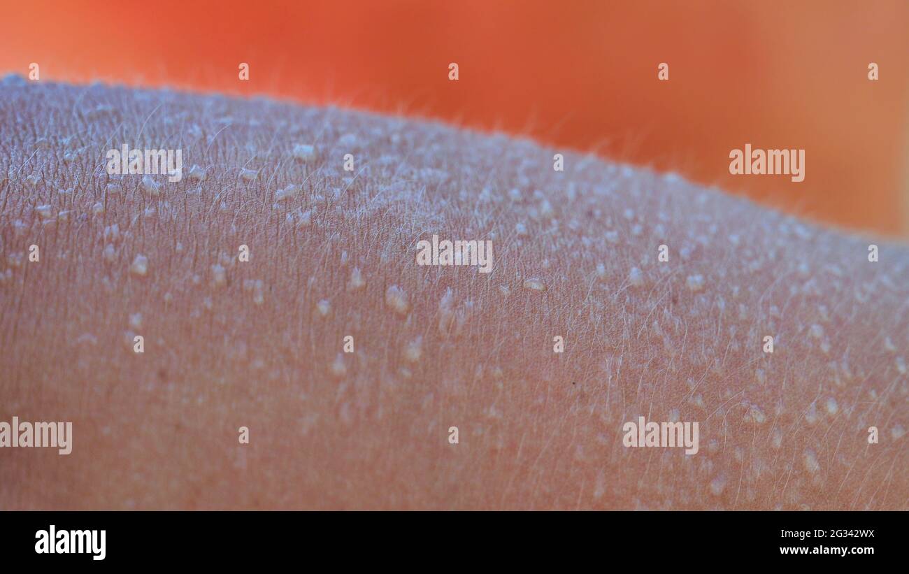 Burn blister arm hi-res stock photography and images - Alamy