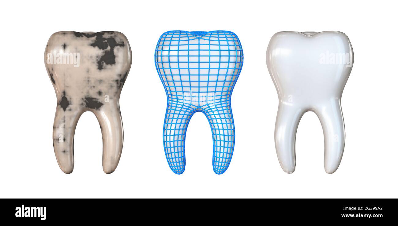 Stages of tooth healing 3D render illustration isolated on white ...