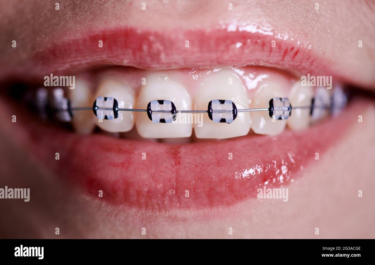 Horizontal close-up snapshot of beautiful woman's smile, demonstrating ...