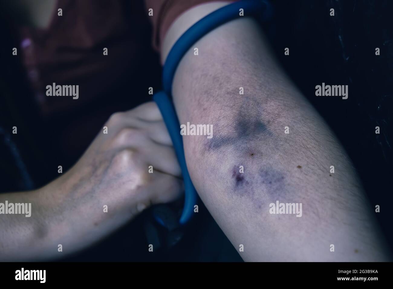 Hematoma arm hi-res stock photography and images - Alamy