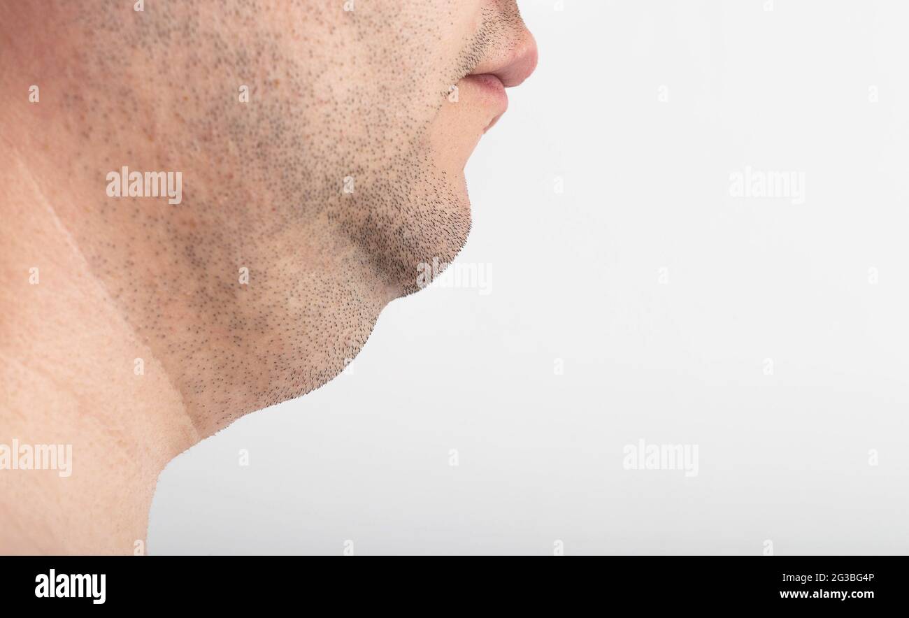 A man has a thick double chin, close-up. Correction and removal of fat ...