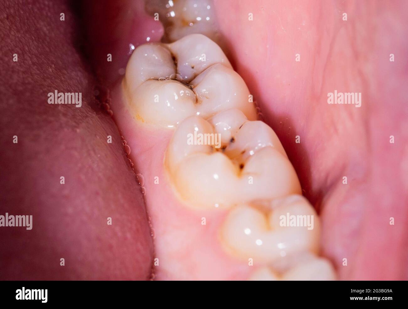 Caries in the mouth on the chewing teeth. Installation of high quality ...