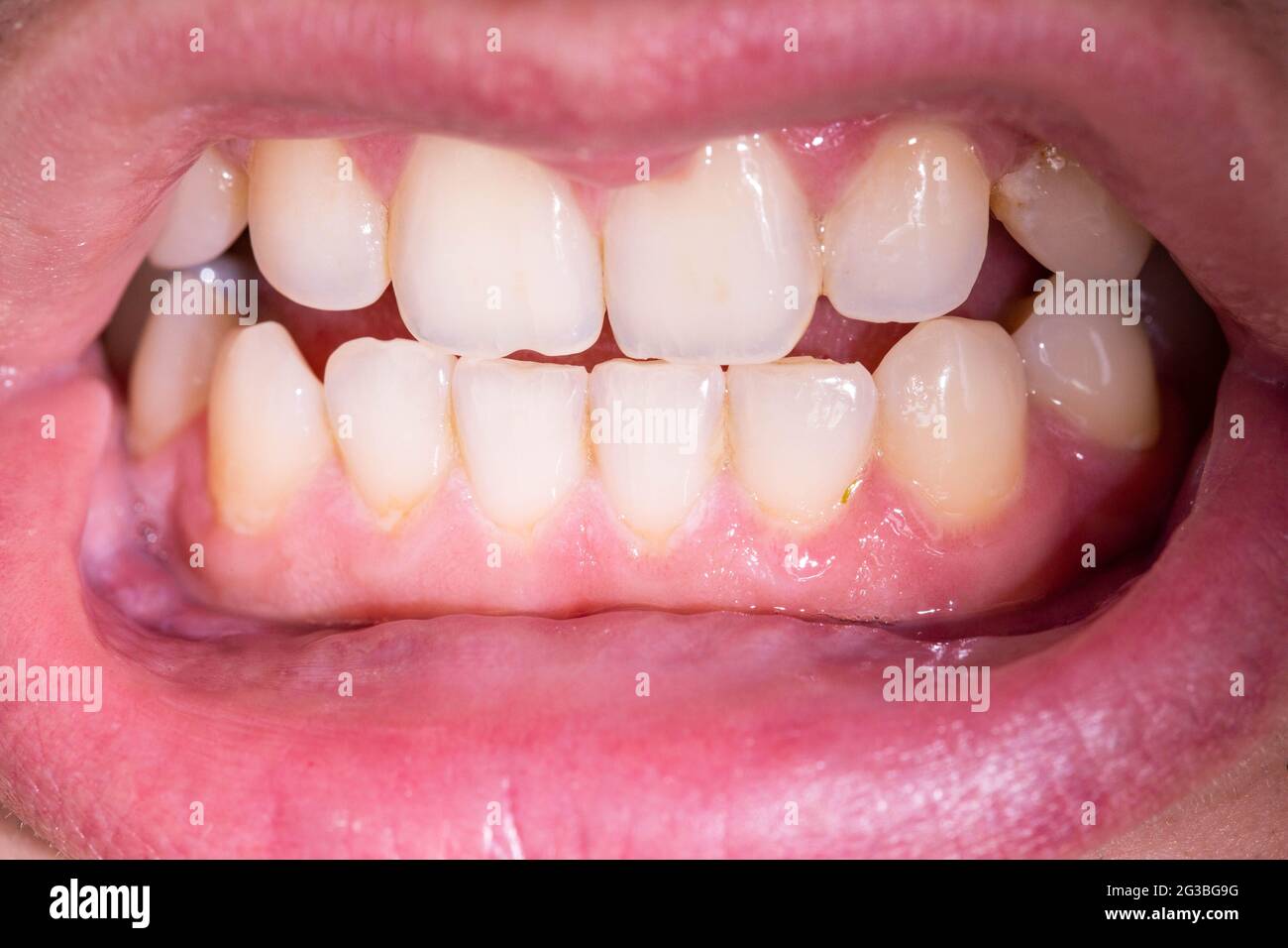 plaque on the teeth of an adult, close-up. Jaw bite and proper dental ...