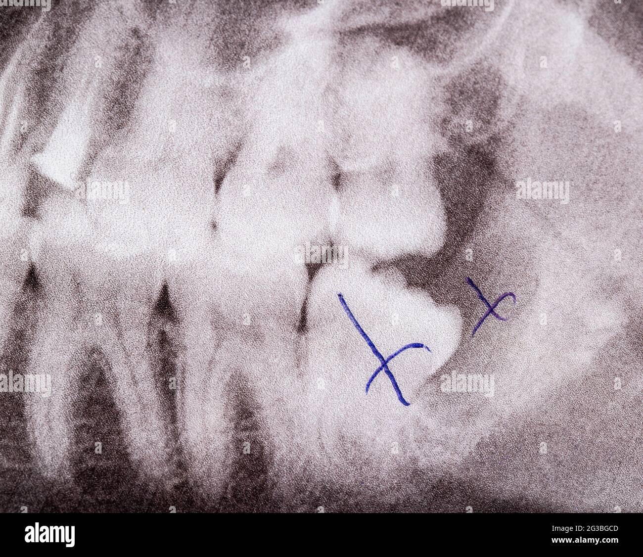X-ray picture of teeth, removal of wisdom tooth and dental inflamed ...